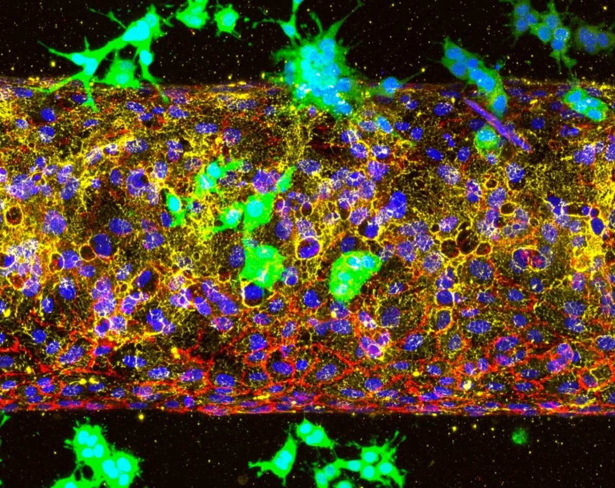 Key driver of pancreatic cancer spread identified | Cornell Chronicle