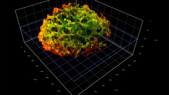 Mineralization of bone matrix regulates tumor cell growth | Cornell ...