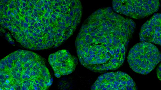 Lab-grown tumors provide insights on rare prostate cancer | Cornell ...