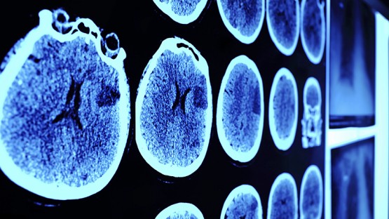 Brain immune cells, neurodegeneration differ in males, females ...