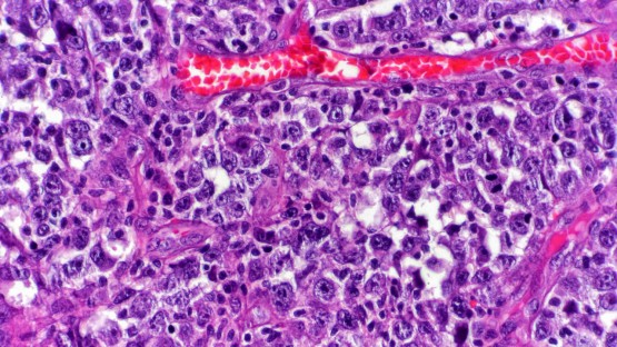 micro lymphoma