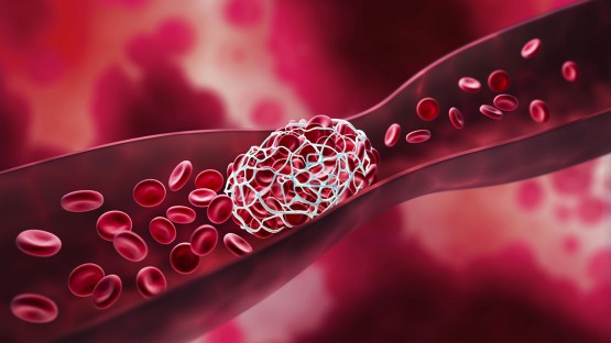 Cancer’s ripple effect may promote blood clots in lungs | Cornell Chronicle
